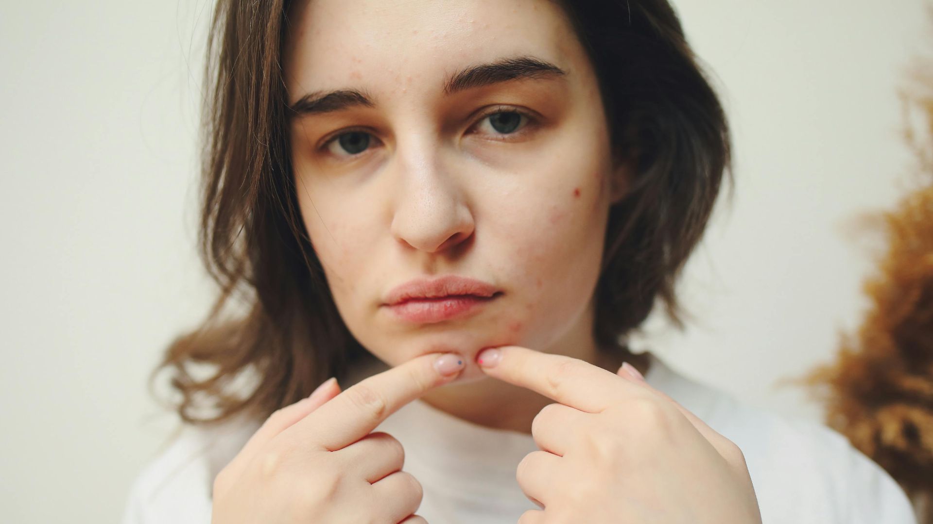 20 Foods To Avoid That Give You Pimples - SheFashionable